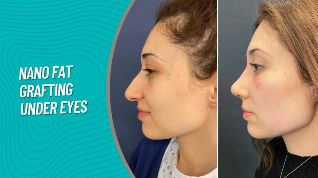Nano Fat Grafting Under Eyes. 2025