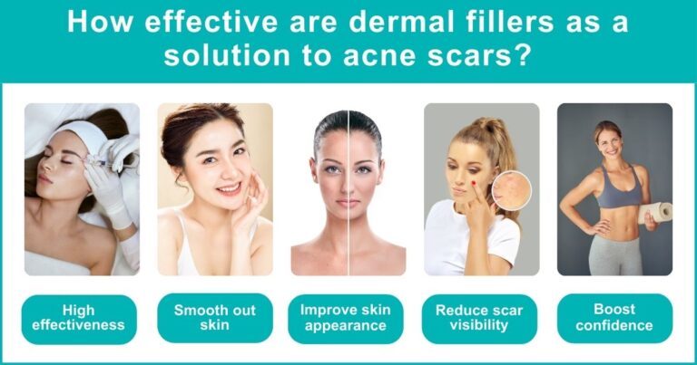 Dermal Fillers As A Solution To Acne Scars 2025