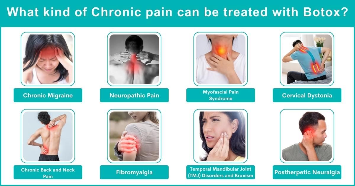 The Role Of Botox In Treating Chronic Pain 2025