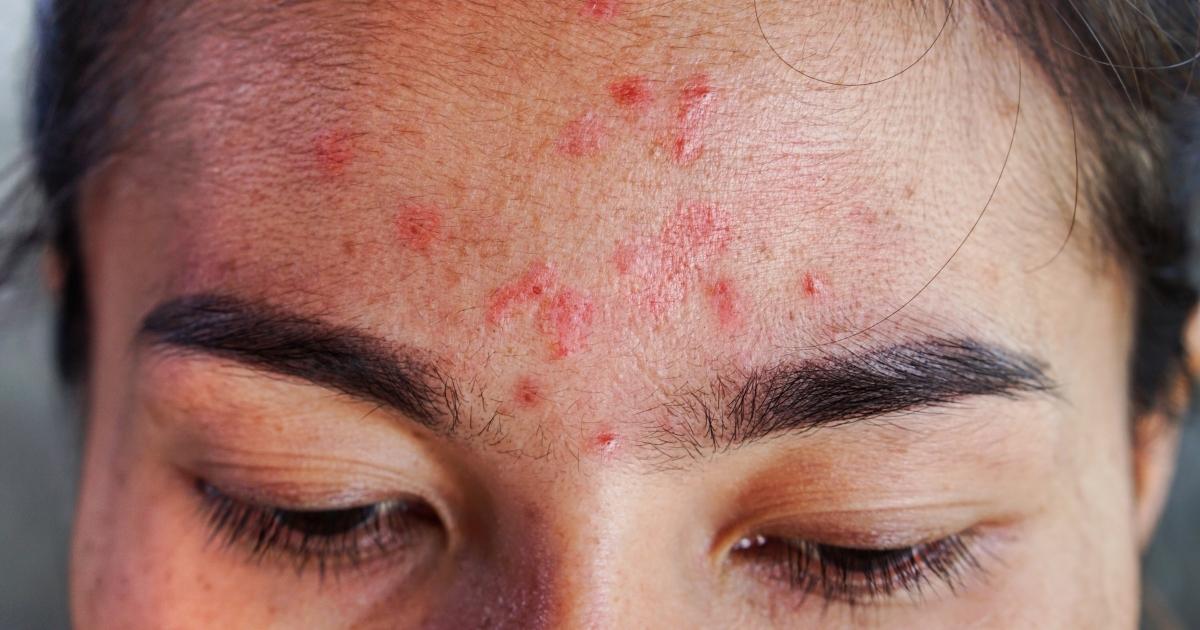 Long-Term Use Of Botox: What Does The Research Say? 2025